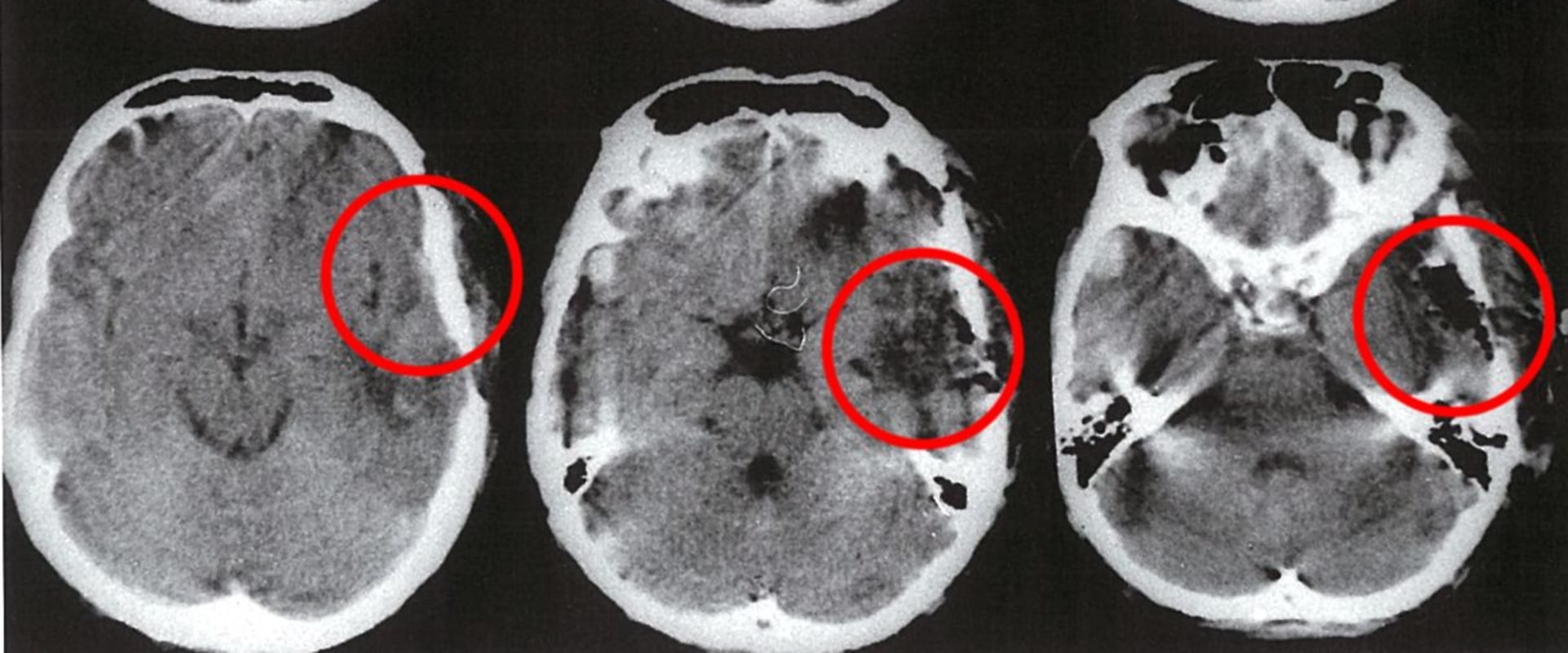 4 Types of Primary Headaches: An Expert's Guide